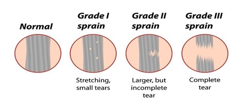 Medial Collateral Ligament Injury Treatment in Dwarka
